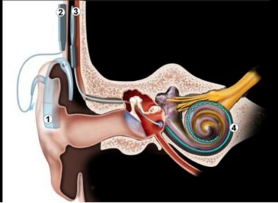 Cochlear implants: overview – Voyage au centre de l'audition
